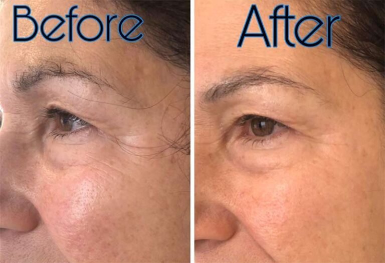 Microchanneling Before and After Treatment (With Pictures)