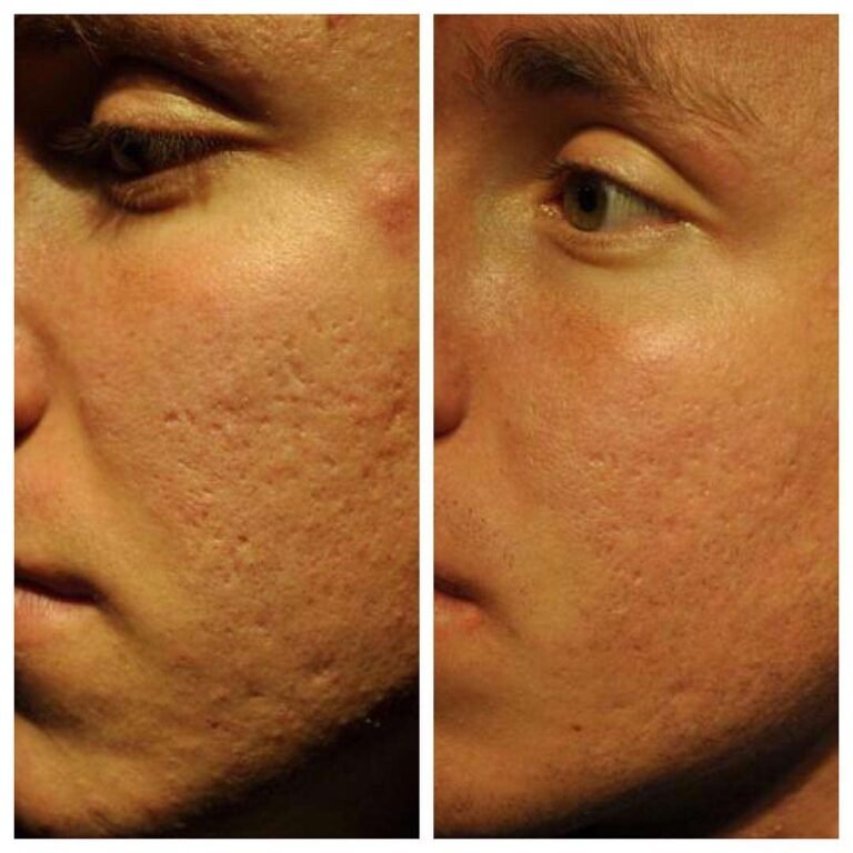 Microchanneling Before and After Treatment (With Pictures)